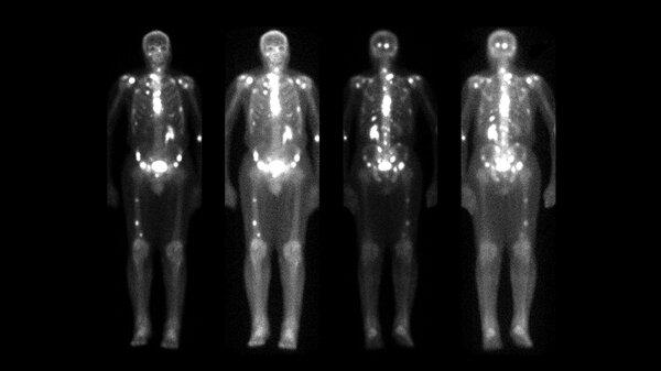 ZOLEDRO-Denk 4 mg/5 ml Konz.z.Herst.e.Inf.-Lsg. - Beipackzettel ...