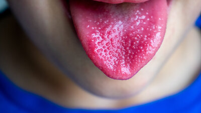 Mandelentzündung erkennen und behandeln | Apotheken Umschau