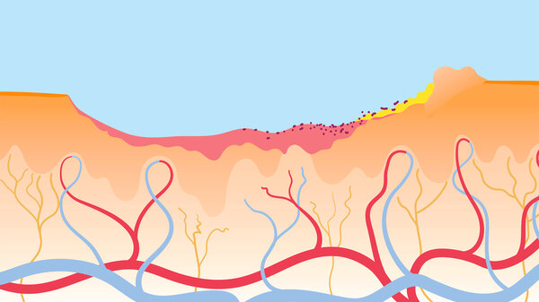Malum perforans | Apotheken Umschau