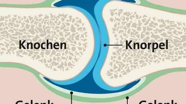 Knorpel im Knie aufbauen: Für wen die Behandlung in Frage kommt ...