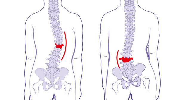Brustwirbelsäulensyndrom (BWS): Das können Sie tun | Apotheken Umschau