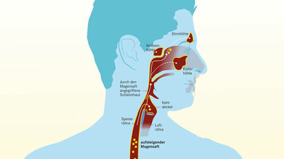Räuspern: Was steckt dahinter? | Apotheken Umschau