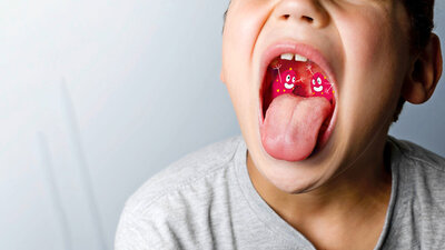 Mandelentzündung bei Kindern | Apotheken Umschau