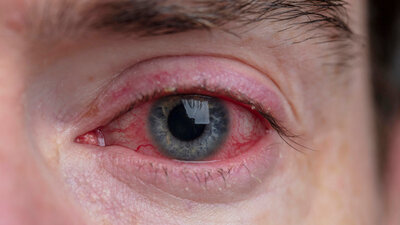 Rotes (trockenes) Auge: Ursachen, Hilfen | Apotheken Umschau