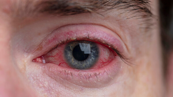 Rotes (trockenes) Auge: Ursachen, Hilfen | Apotheken Umschau