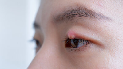 Lidekzem – welche Ursachen gibt, was man tun kann | Apotheken Umschau