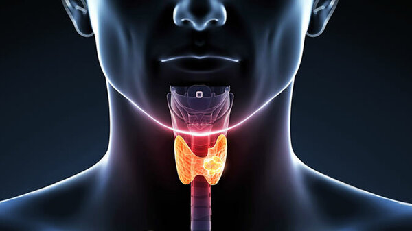 Leben mit Morbus Basedow: Was muss ich wissen? | Apotheken Umschau