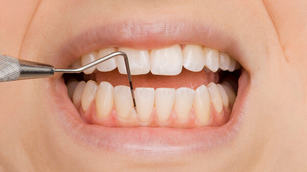 Karies – Wie entsteht sie und was hilft dagegen? | Apotheken Umschau