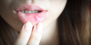 Aphthen: Symptome, Ursachen, Behandlung | Apotheken Umschau