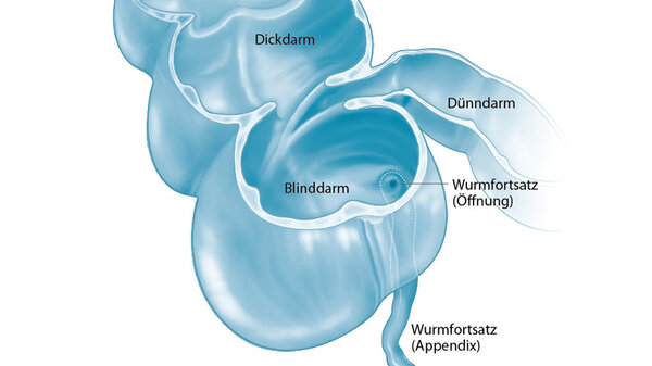Mandel-OP: Wann ist eine Mandelentfernung bei Erwachsenen sinnvoll ...