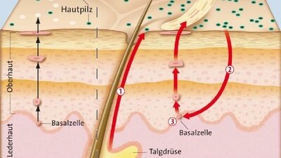 Lichen ruber planus (Knötchenflechte) | Apotheken Umschau