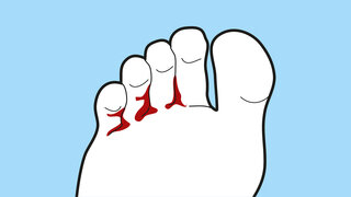 Mykose | Apotheken Umschau