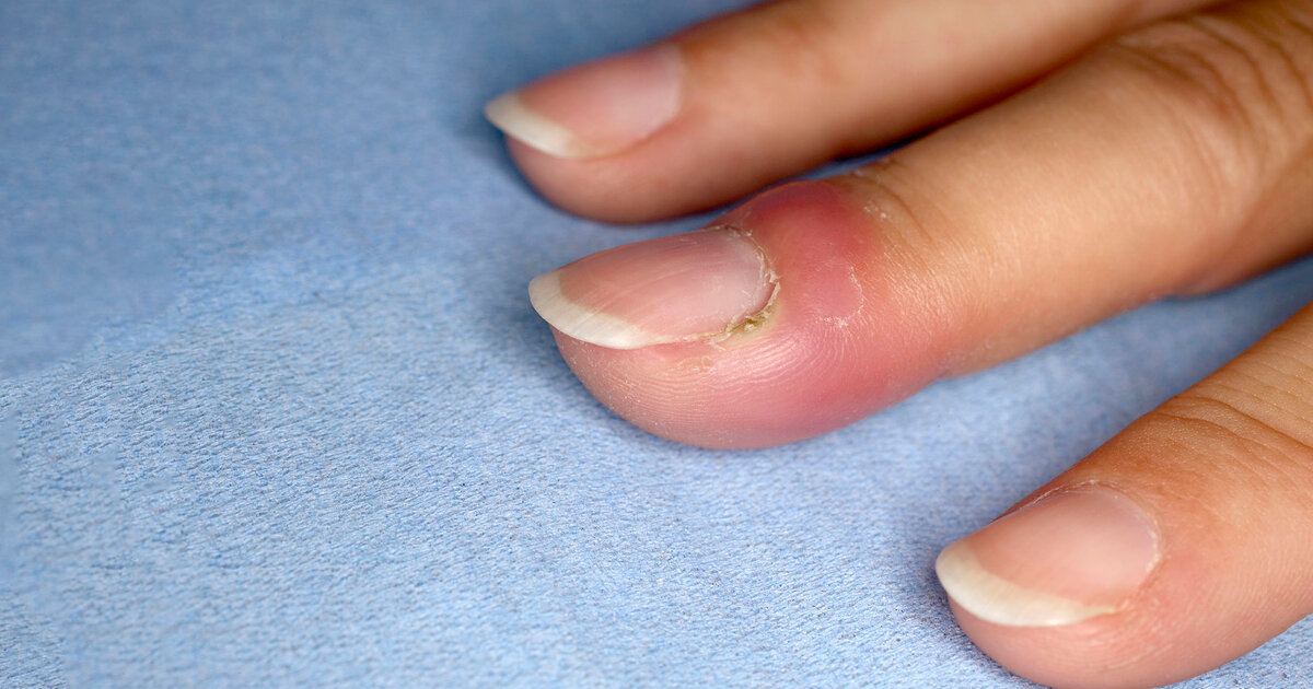 Nagelbettentzündung: Symptome und Behandlung | Apotheken Umschau