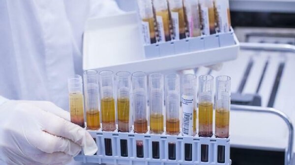 Blutuntersuchung: Leberwerte | Apotheken Umschau