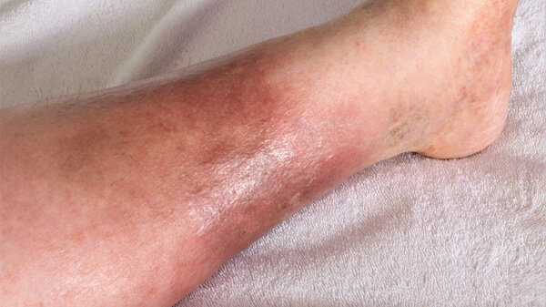 Röschenflechte (Pityriasis rosea) | Apotheken Umschau