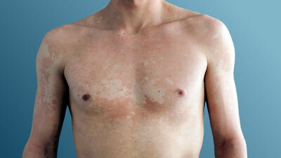 Röschenflechte (Pityriasis rosea) | Apotheken Umschau