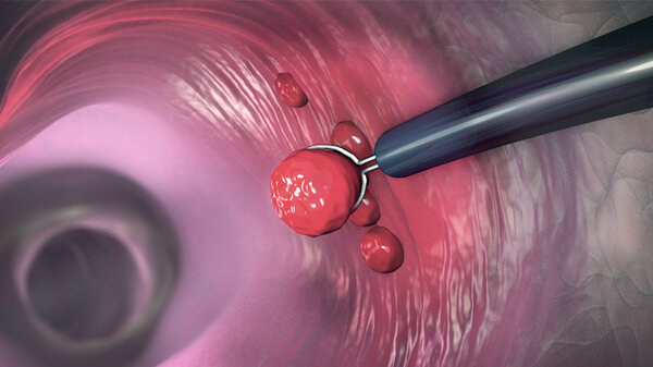 Was wird bei einer Konisation gemacht? | Apotheken Umschau