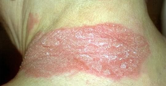 Mycosis fungoides: Symptome | Apotheken Umschau