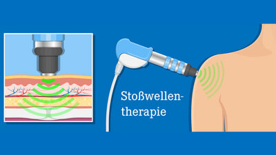 Erektile Dysfunktion: Ursachen und Behandlung | Apotheken Umschau