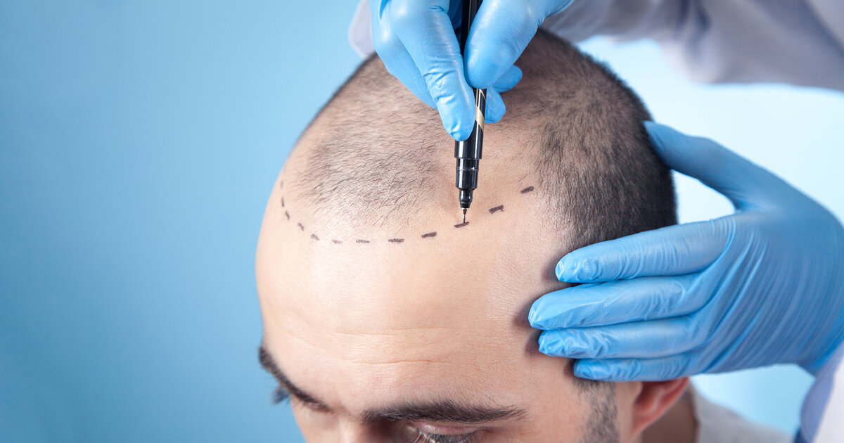 Haartransplantation bei Geheimratsecken und Glatze | Apotheken Umschau