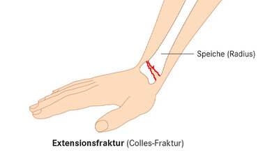 Hand gebrochen: Symptome, Diagnose und Behandlung | Apotheken Umschau