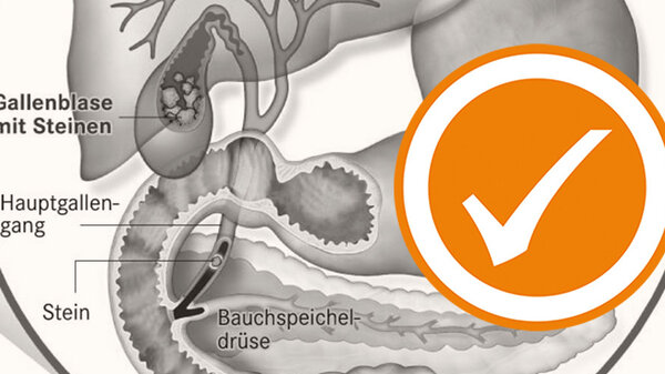 Gallensteine: Behandlung nicht immer nötig | Apotheken Umschau
