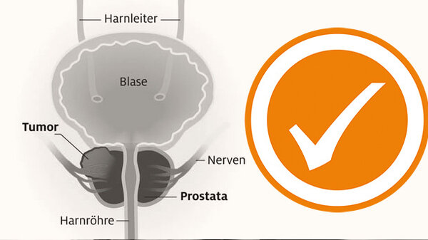Prostatakrebs: Symptome, Diagnose, Therapie | Apotheken Umschau